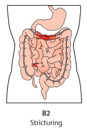 Surgery for IBD complications - Gut Smart